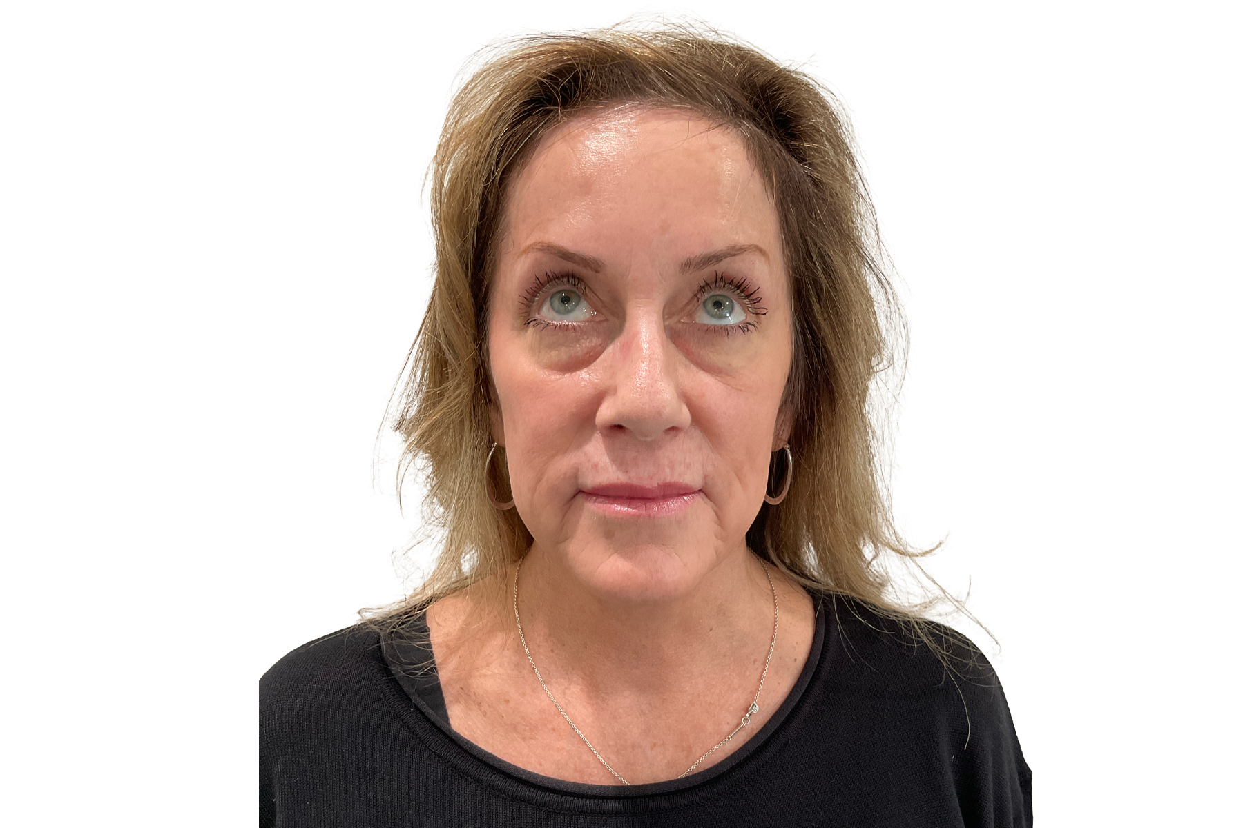 Women's Blepharoplasty by Dr. Khairalla at bŏdze