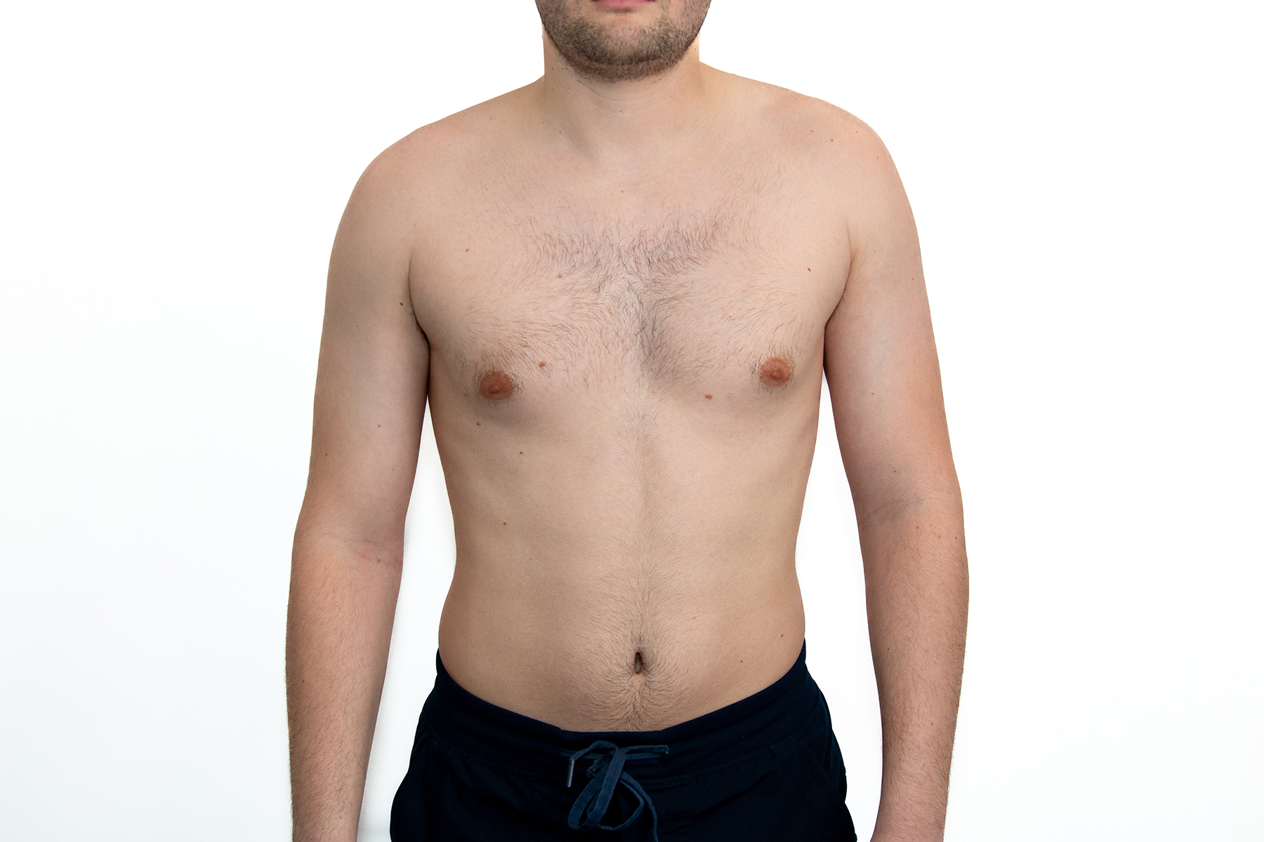 Men's Gynecomastia by Dr. Khairalla at bŏdze